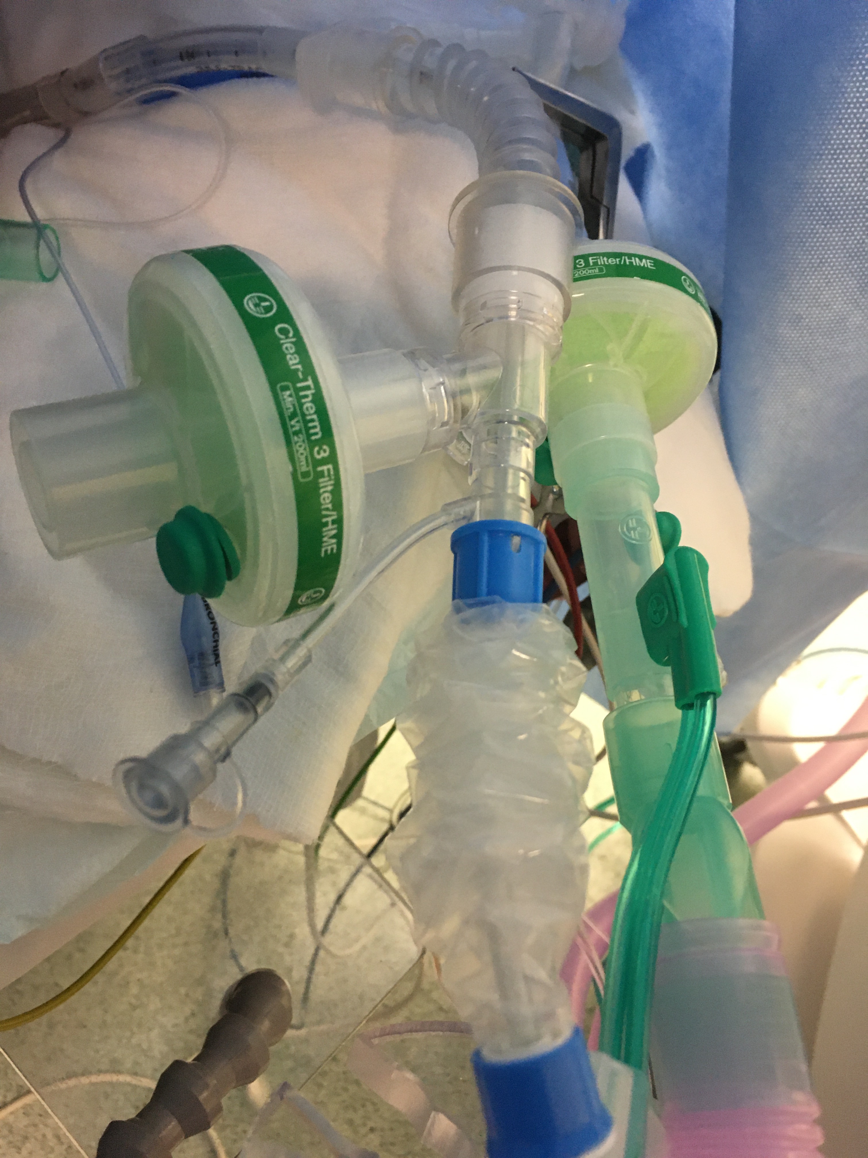 A suggestion for safe lung deflation during one-lung ventilation in ...
